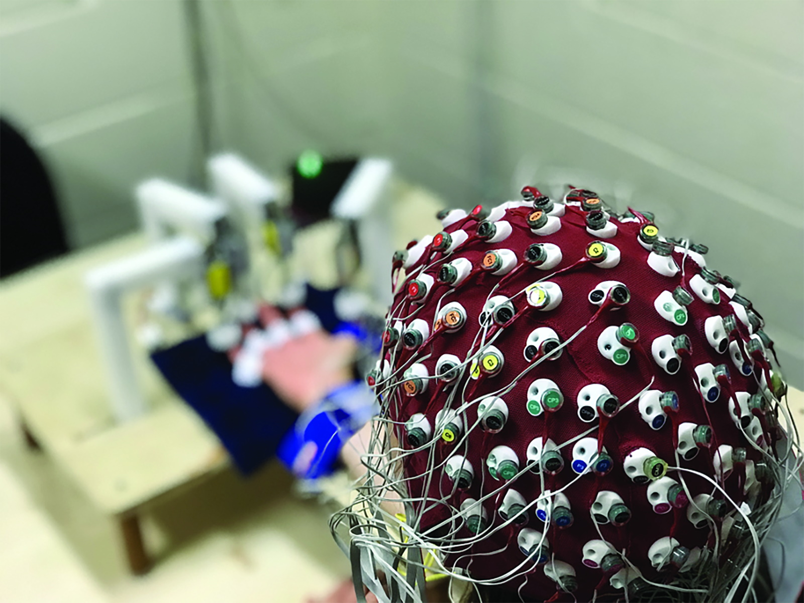 What if electrical stimulation could treat phantom limb pain? - Futurum